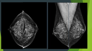 Digital Breast Tomosynthesis | PPTX