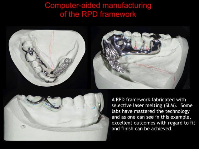 Digital Design of Mandibular Removable Partial Dentures | PDF