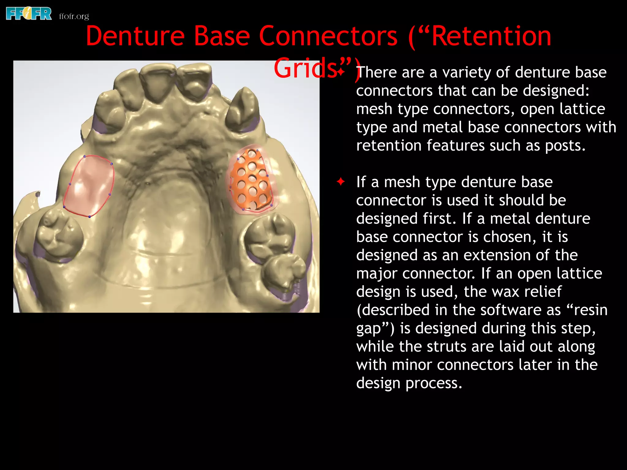Digital design of maxillary of rpd's | PDF
