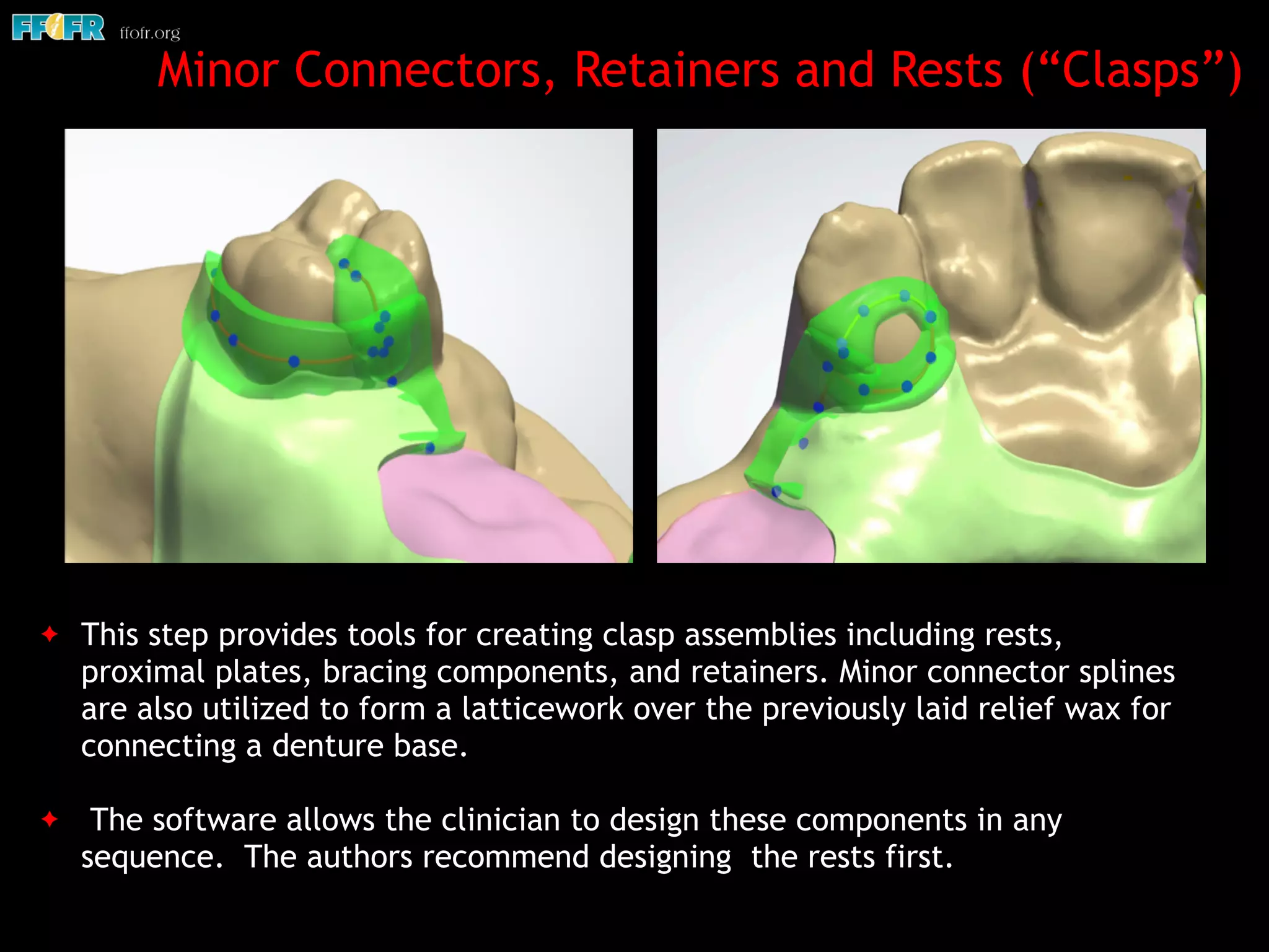 Digital design of maxillary of rpd's | PDF