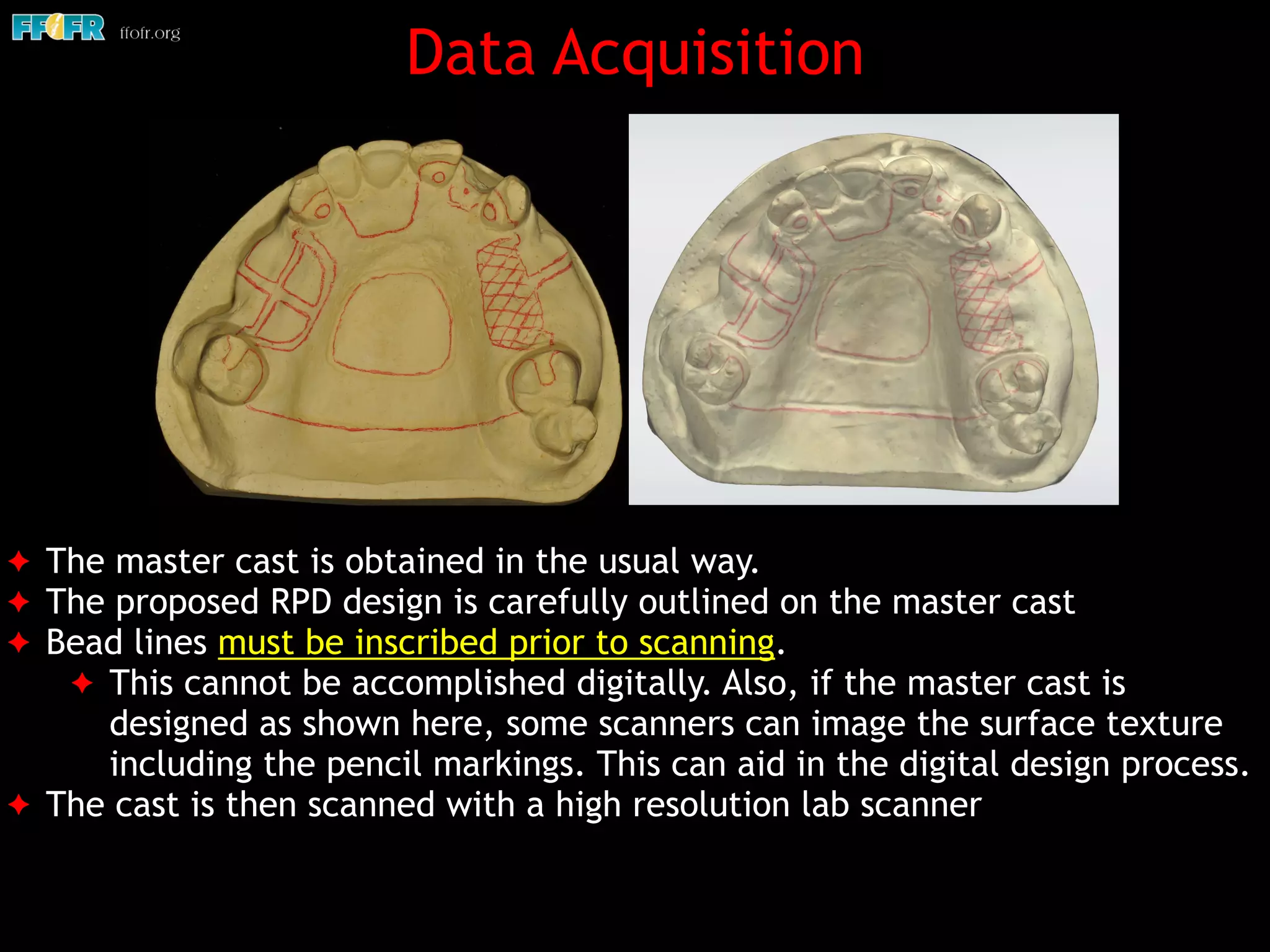 Digital design of maxillary of rpd's | PDF
