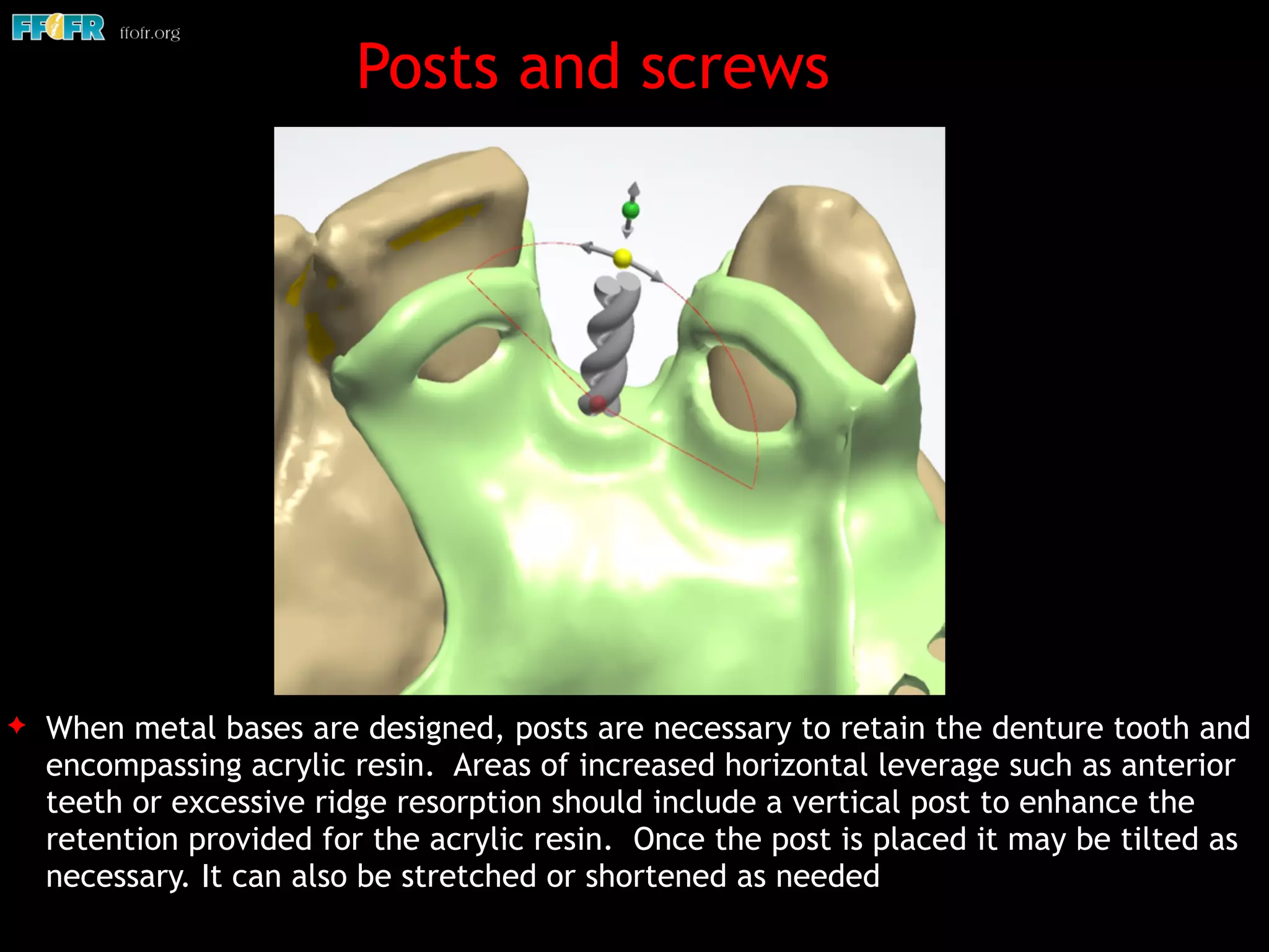 Digital design of maxillary of rpd's | PDF