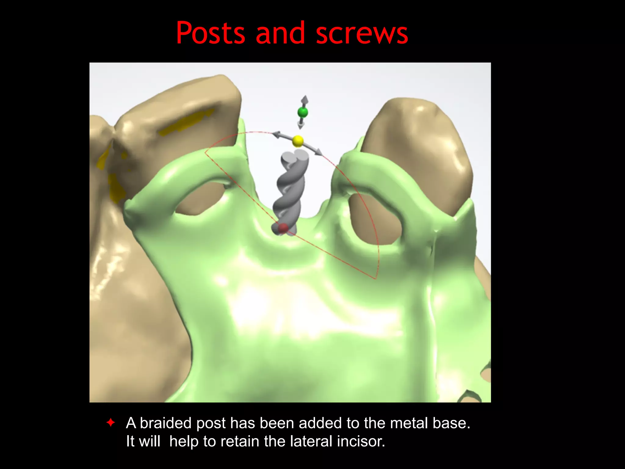 Digital design of maxillary of rpd's | PDF