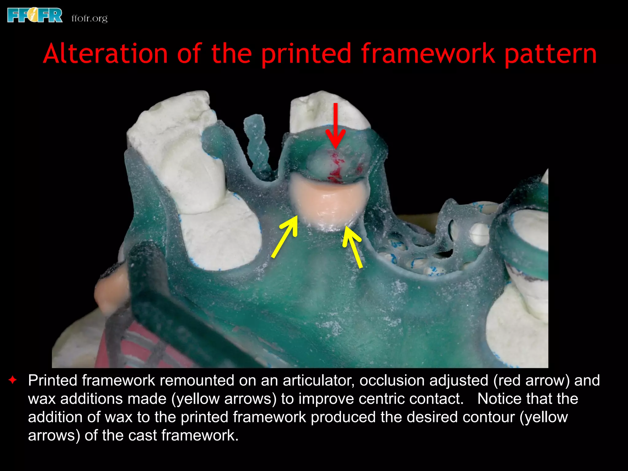 Digital design of maxillary of rpd's | PDF
