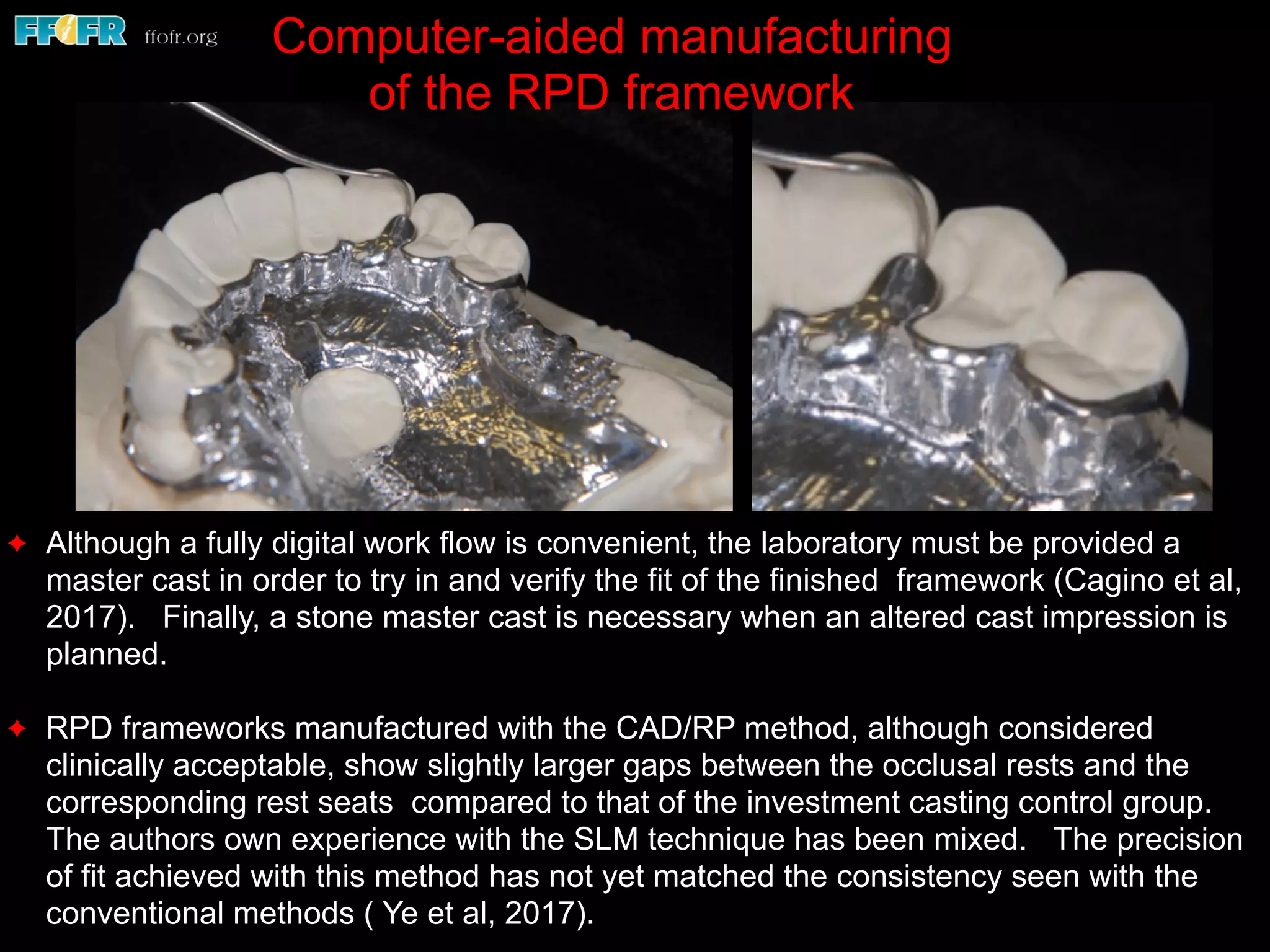 Digital design of maxillary of rpd's | PDF