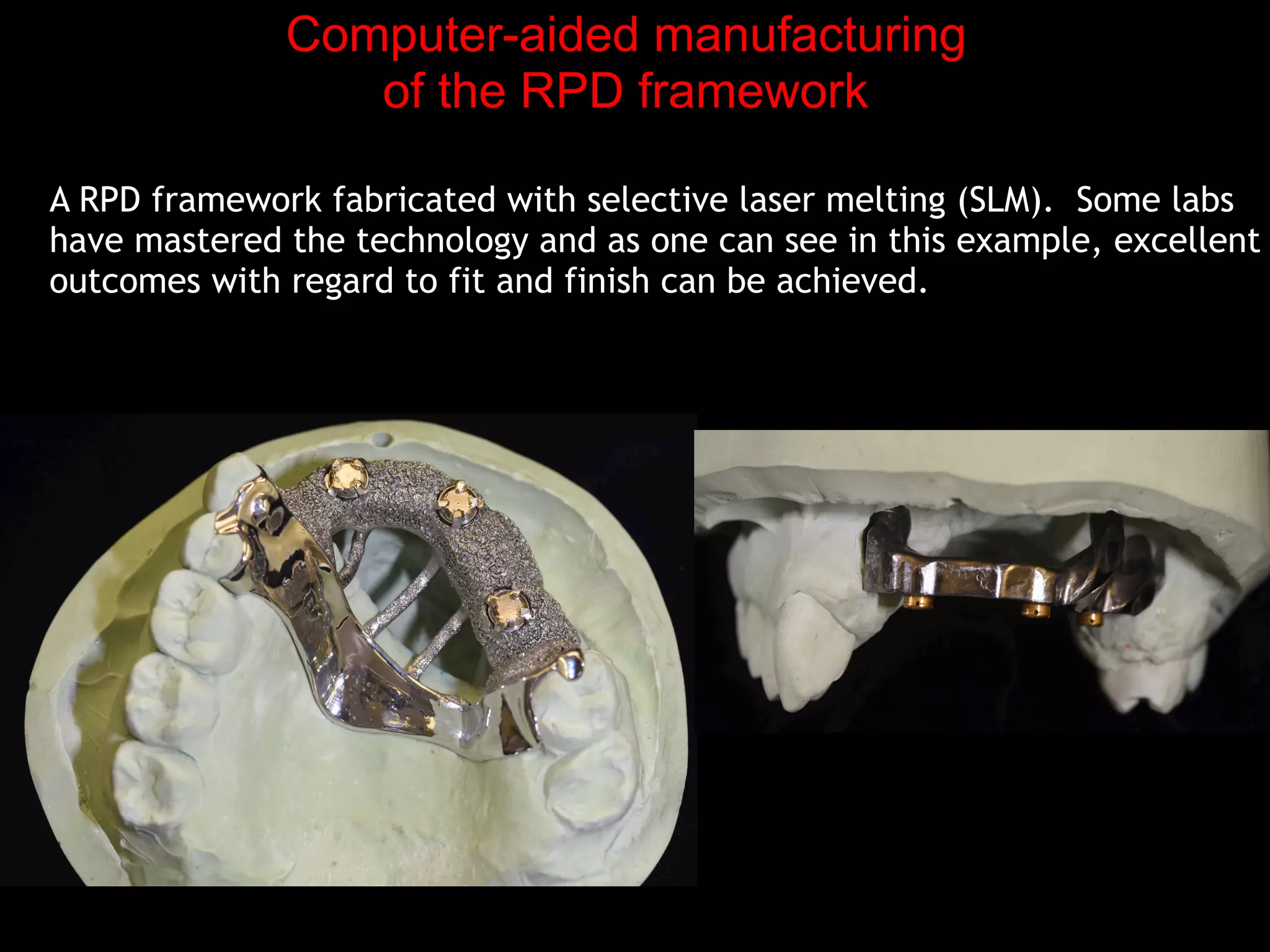 Digital design of maxillary of rpd's | PDF