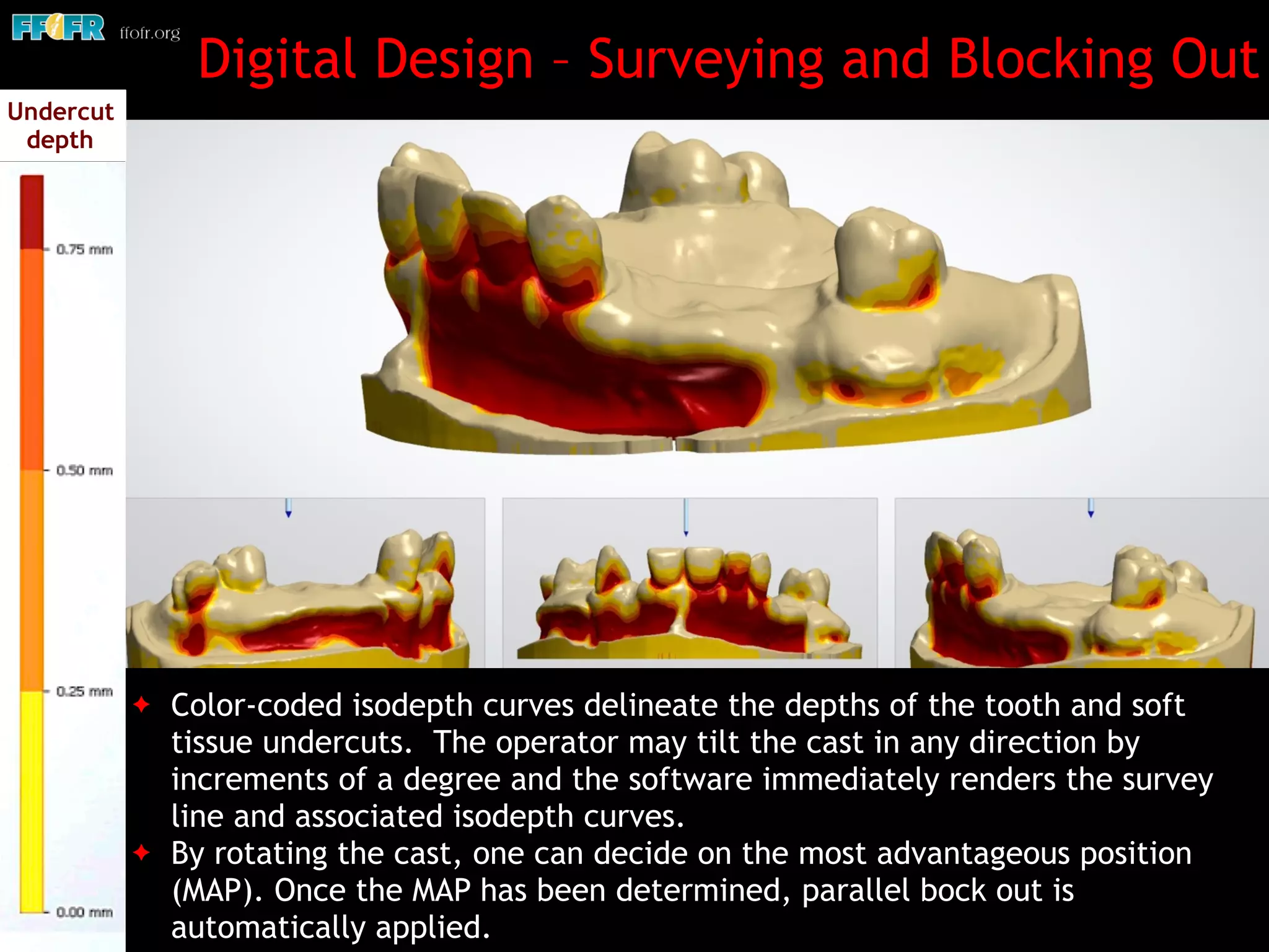 Digital design of maxillary of rpd's | PDF