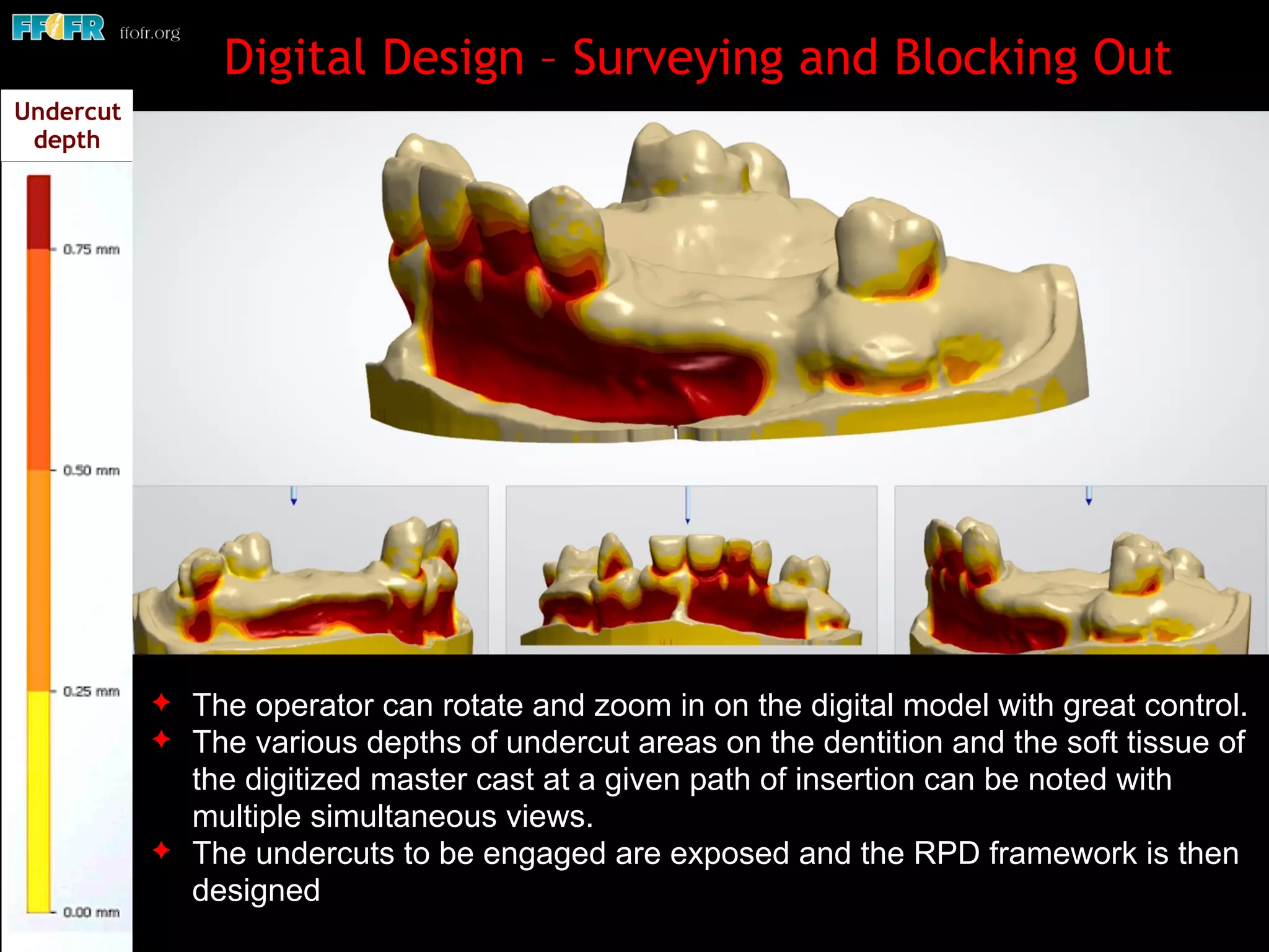 Digital design of maxillary of rpd's | PDF