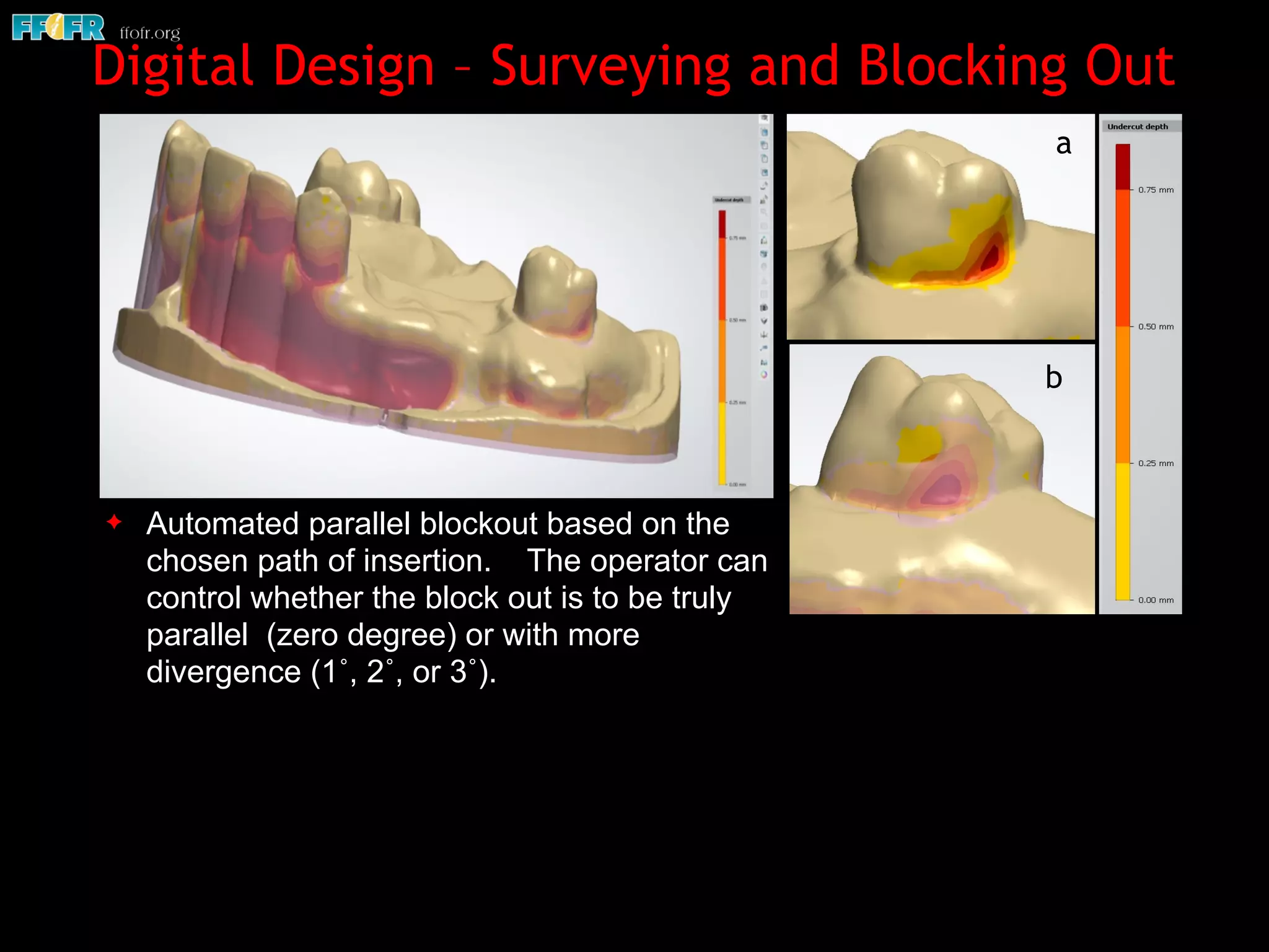 Digital design of maxillary of rpd's | PDF