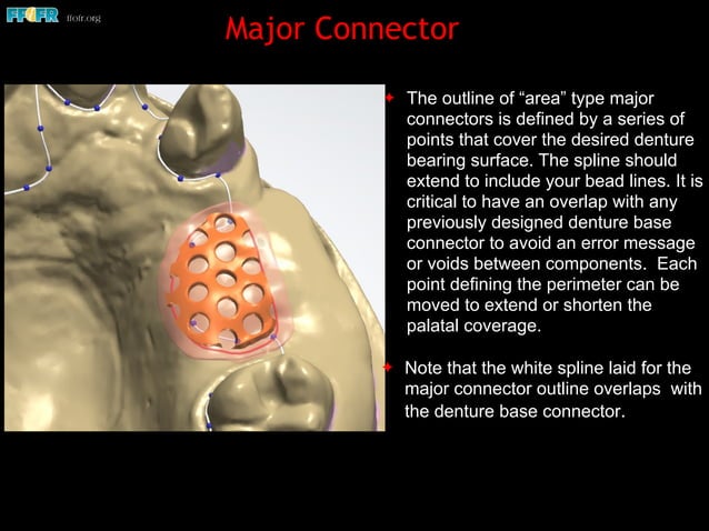 Digital design of maxillary of rpd's | PDF