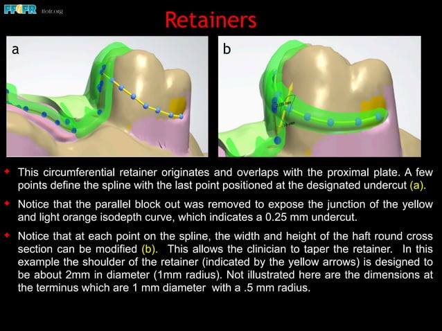 Digital design of maxillary of rpd's | PDF