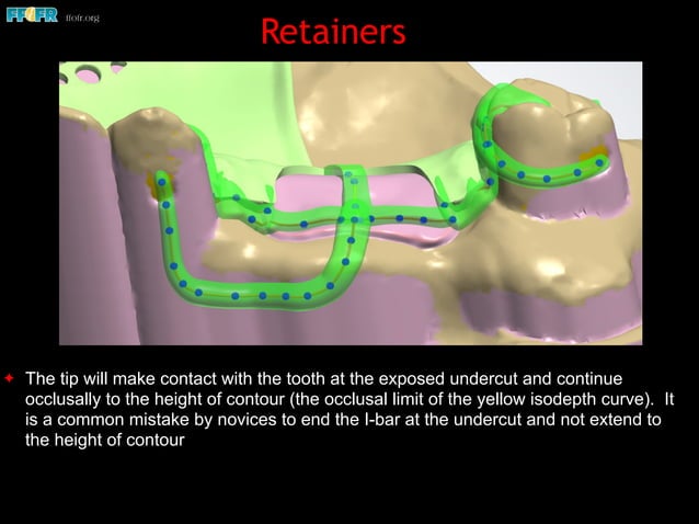 Digital design of maxillary of rpd's | PDF