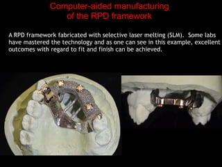 Digital design of maxillary of rpd's | PPT