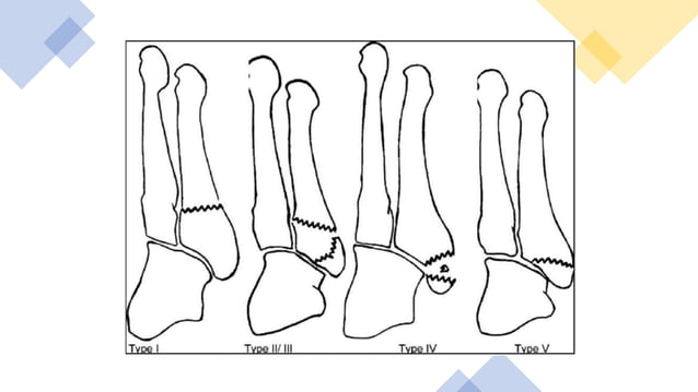 AJM Sheet: Digital fracture | PPT