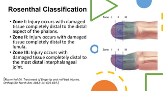 AJM Sheet: Digital fracture | PPT