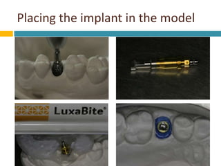Digital implant planning and guide | PPTX
