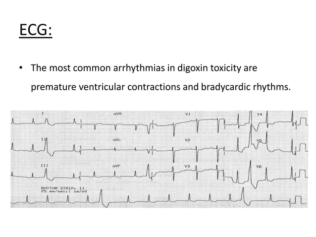 DIGITALIS GLYCOSIDE TOXICITY ED management | PPTX | Heart and ...