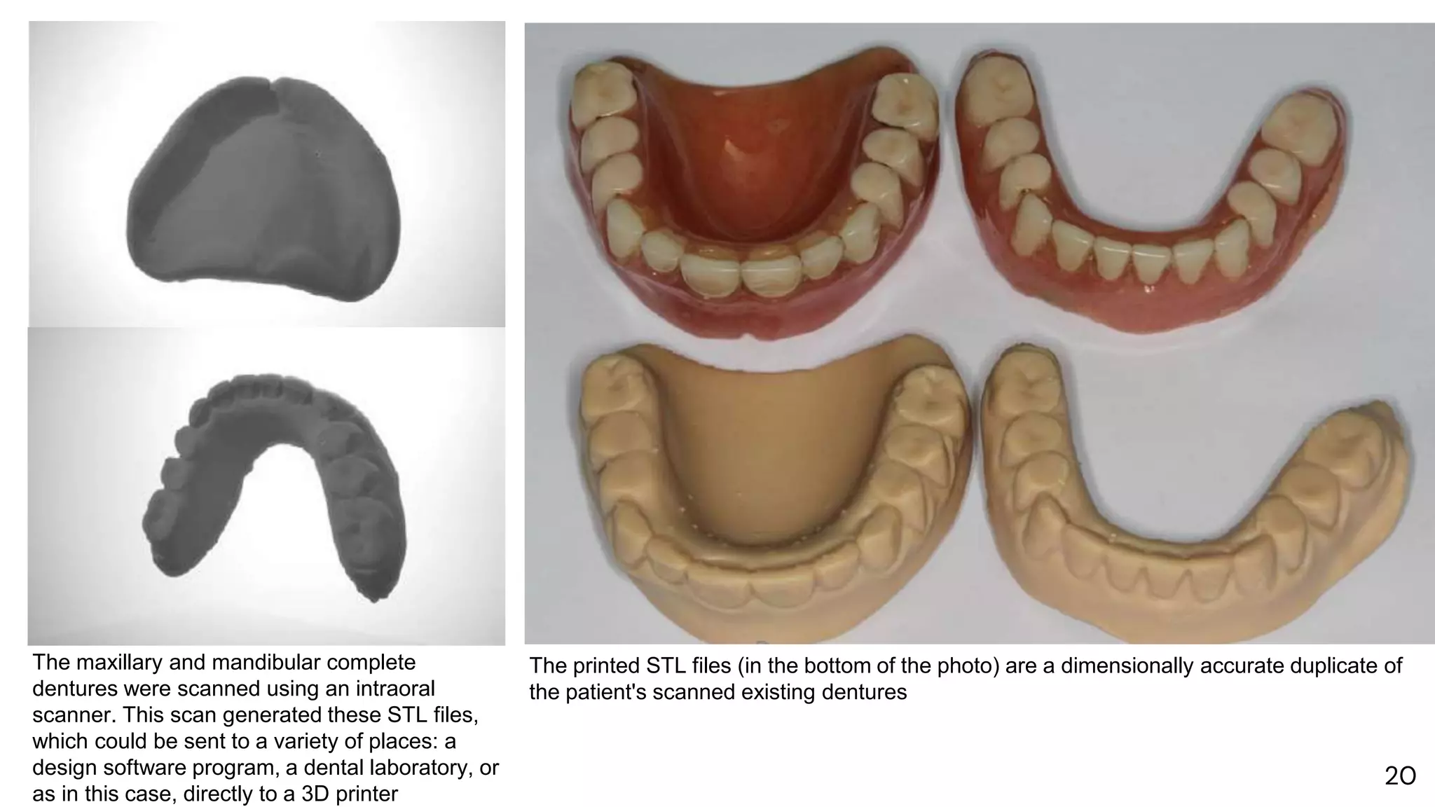 Digital Removable Complete Denture—an Overview.pptx