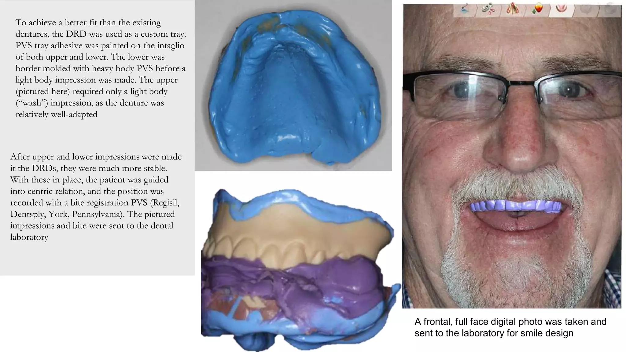 Digital Removable Complete Denture—an Overview.pptx