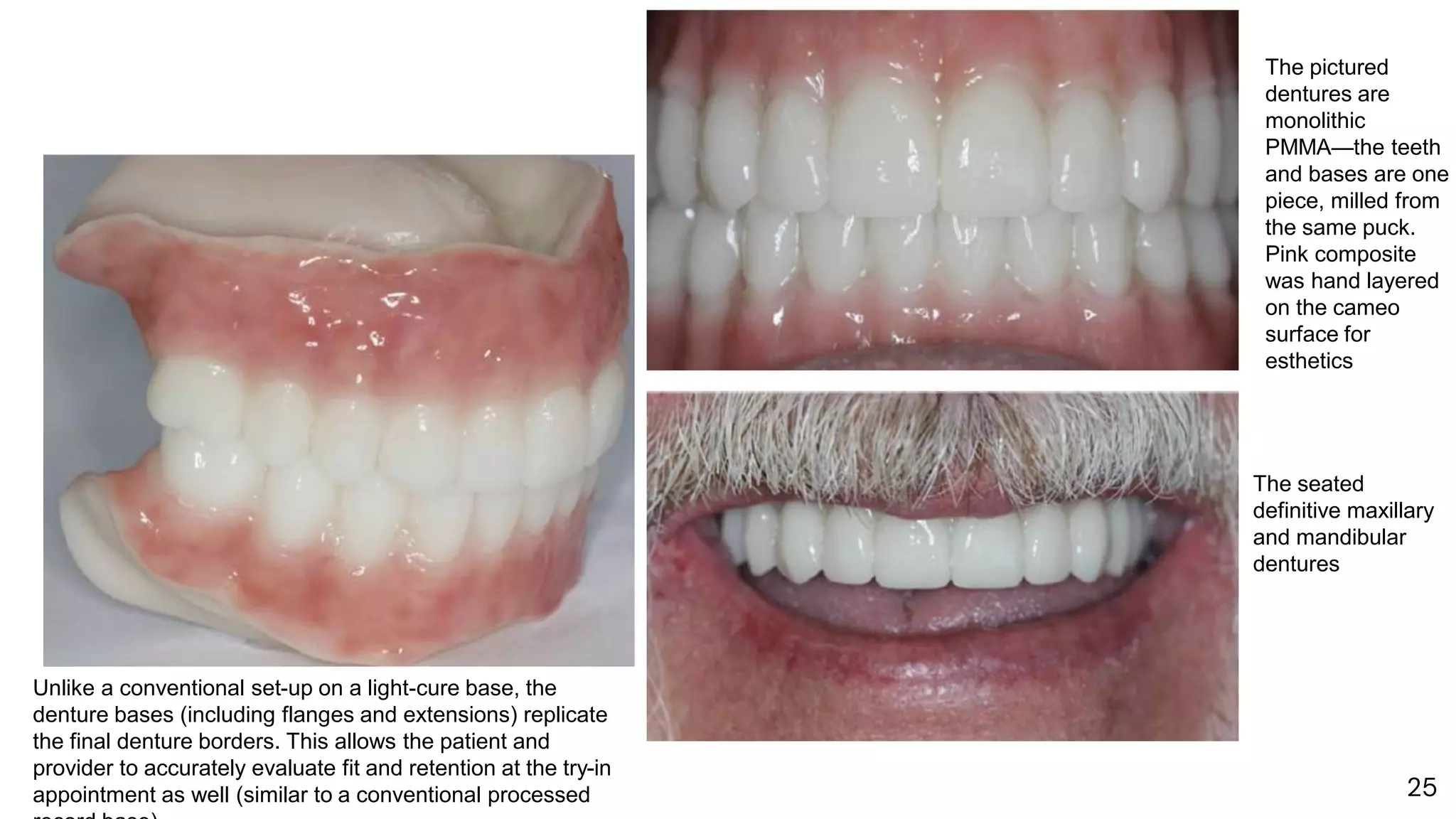 Digital Removable Complete Denture—an Overview.pptx