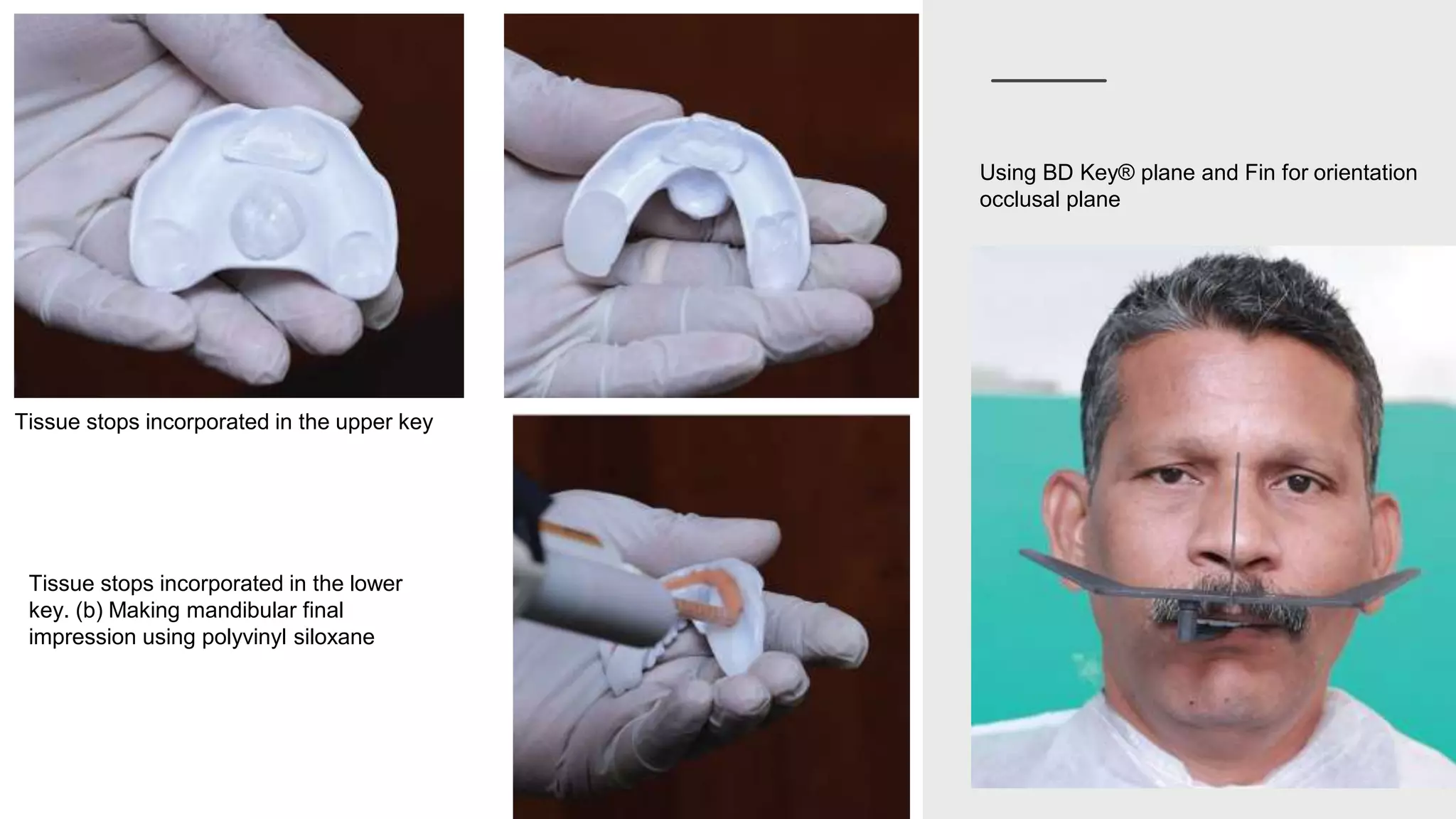 Digital Removable Complete Denture—an Overview.pptx