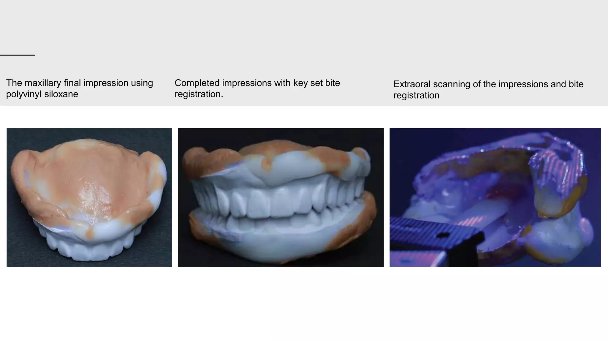 Digital Removable Complete Denture—an Overview.pptx