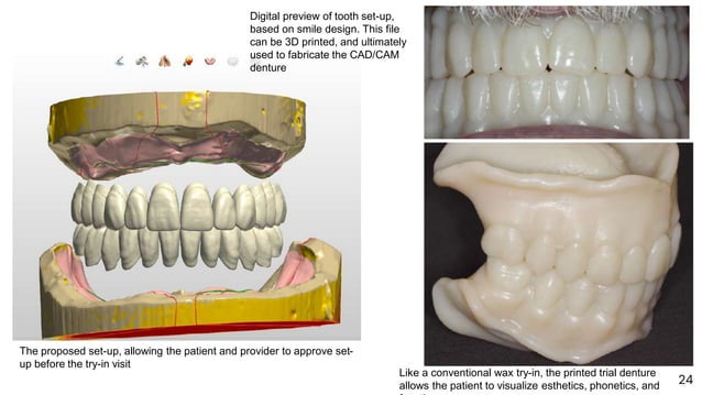 Digital Removable Complete Denture—an Overview.pptx | Dental Health ...