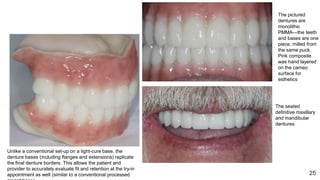 Digital Removable Complete Denture—an Overview.pptx