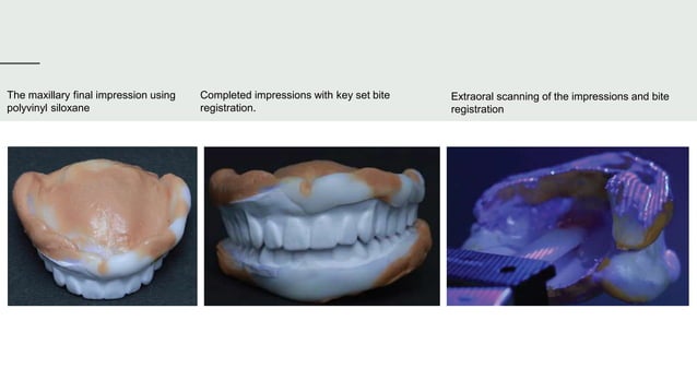Digital Removable Complete Denture—an Overview.pptx | Dental Health ...