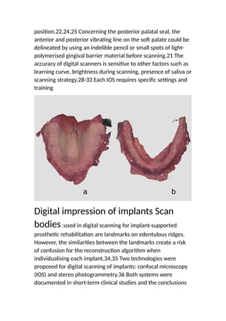 Digital removable complete dentures.docx