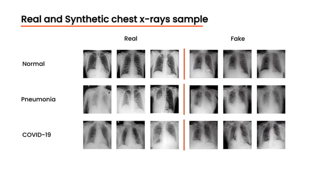 CXR-ACGAN: Auxiliary Classifier GAN for Conditional Generation of Chest X-Ray Images (Pneumonia ...