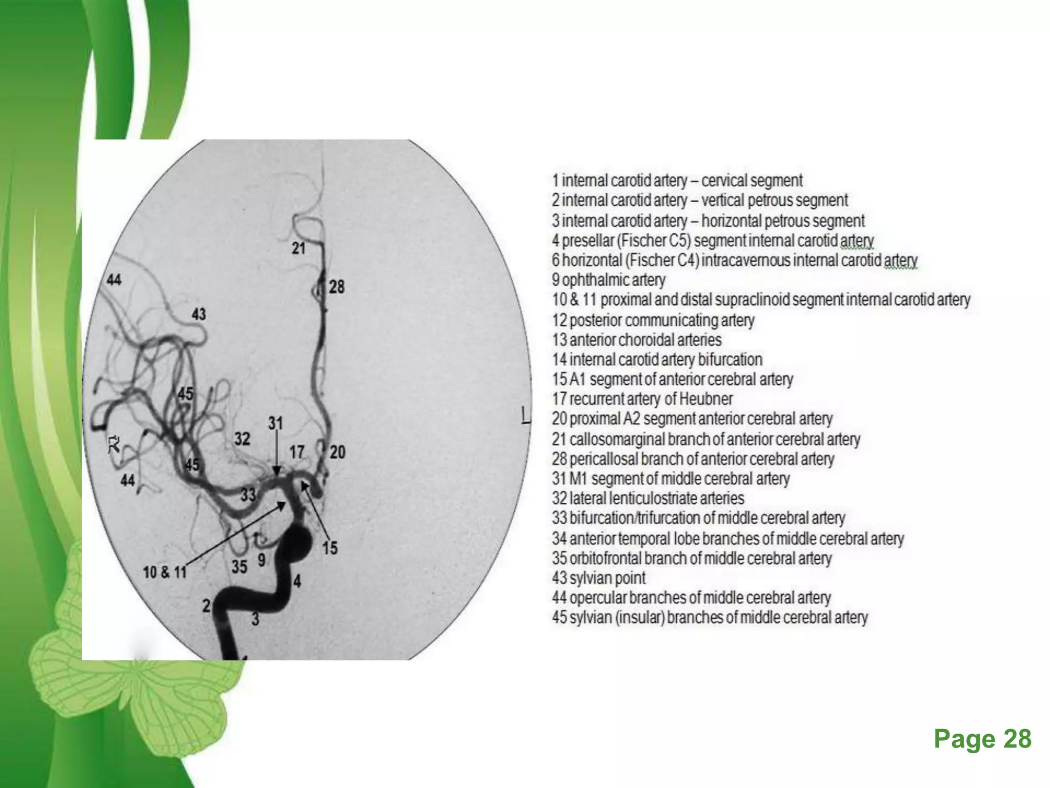 Digital subtraction angiography | PPTX