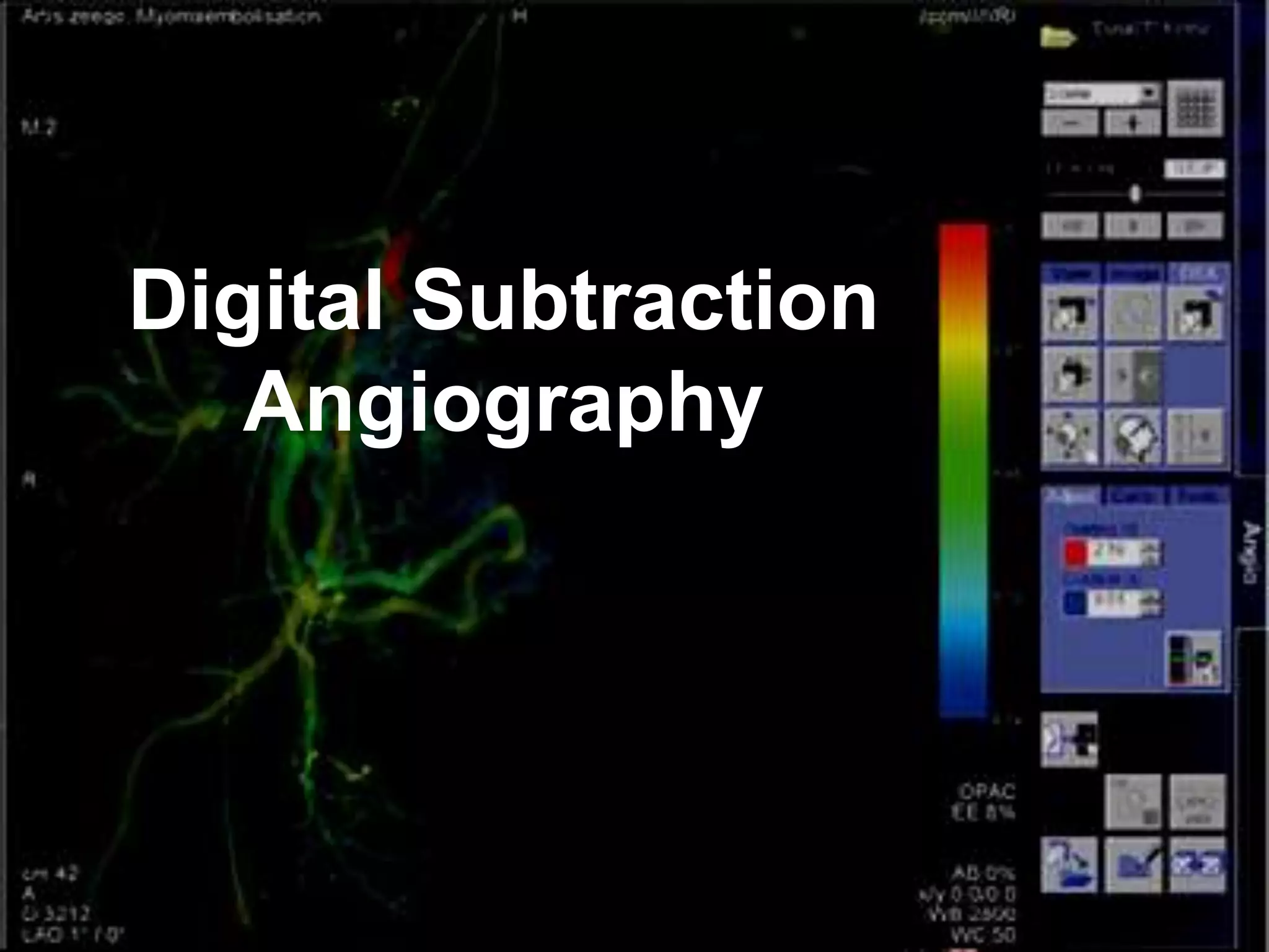 Digital subtraction angiography | PPTX