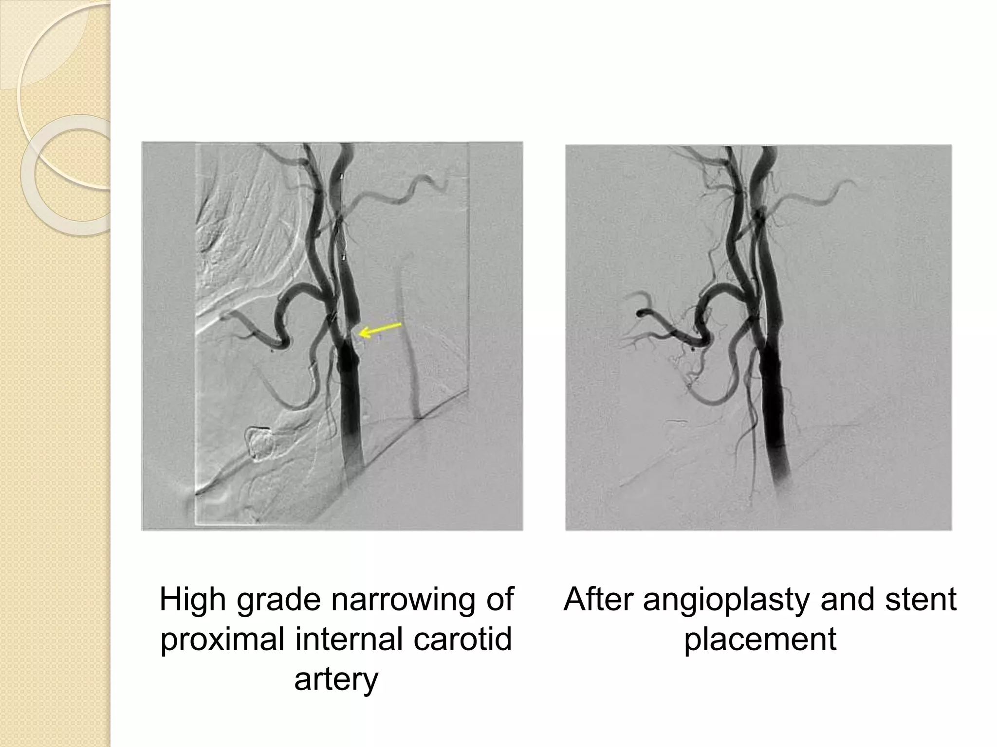 Digital subtraction angiography | PPTX