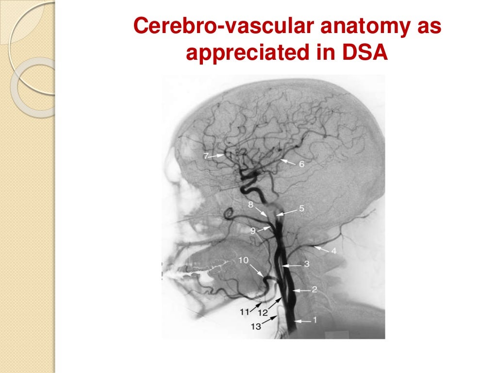 Digital subtraction angiography