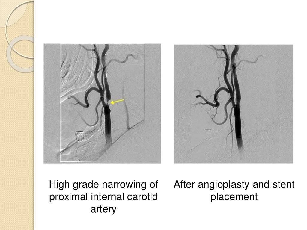 Digital Subtraction Angiography digital-subtraction-angiography