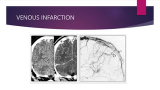 DIGITAL SUBTRACTION ANGIOGRAPHY IN CEREBROVASCULAR DISEASE AND ...