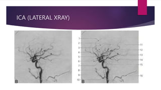 DIGITAL SUBTRACTION ANGIOGRAPHY IN CEREBROVASCULAR DISEASE AND ...
