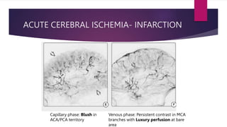 DIGITAL SUBTRACTION ANGIOGRAPHY IN CEREBROVASCULAR DISEASE AND ...
