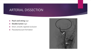 DIGITAL SUBTRACTION ANGIOGRAPHY IN CEREBROVASCULAR DISEASE AND ...