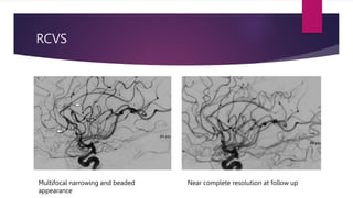DIGITAL SUBTRACTION ANGIOGRAPHY IN CEREBROVASCULAR DISEASE AND ...