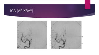 DIGITAL SUBTRACTION ANGIOGRAPHY IN CEREBROVASCULAR DISEASE AND ...