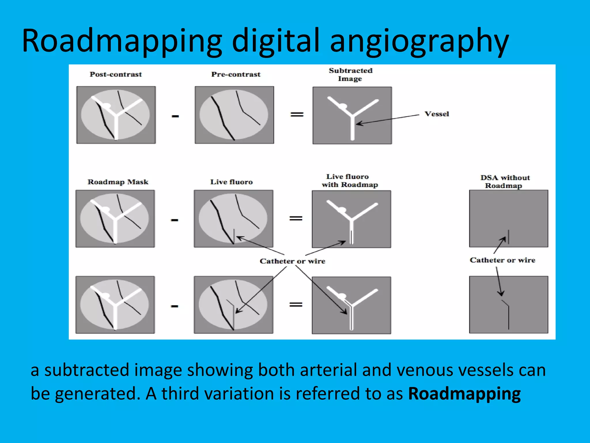 Digital Subtraction Angiography king saud unversity.pdf