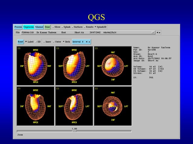 Digital Techniques For Myocardial Perfusion Spect | PPTX | Photo ...