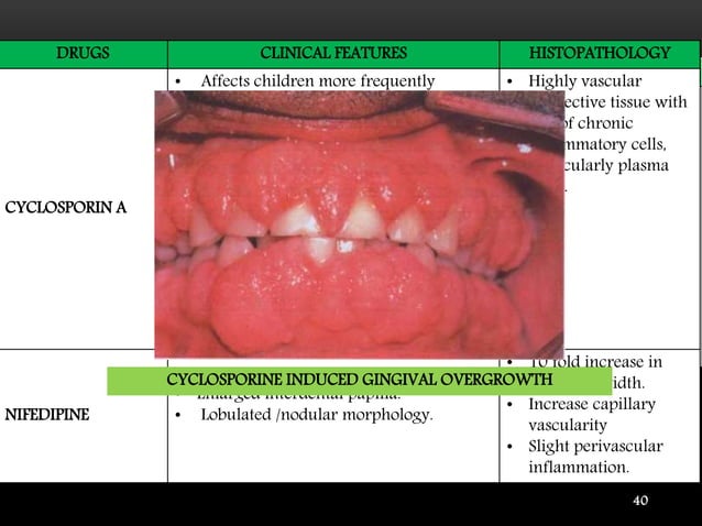 DRUG INDUCED GINGIVAL ENLARGMENT (DIGO) | PPT