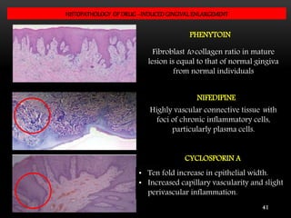 Gingival Hyperplasia Histology