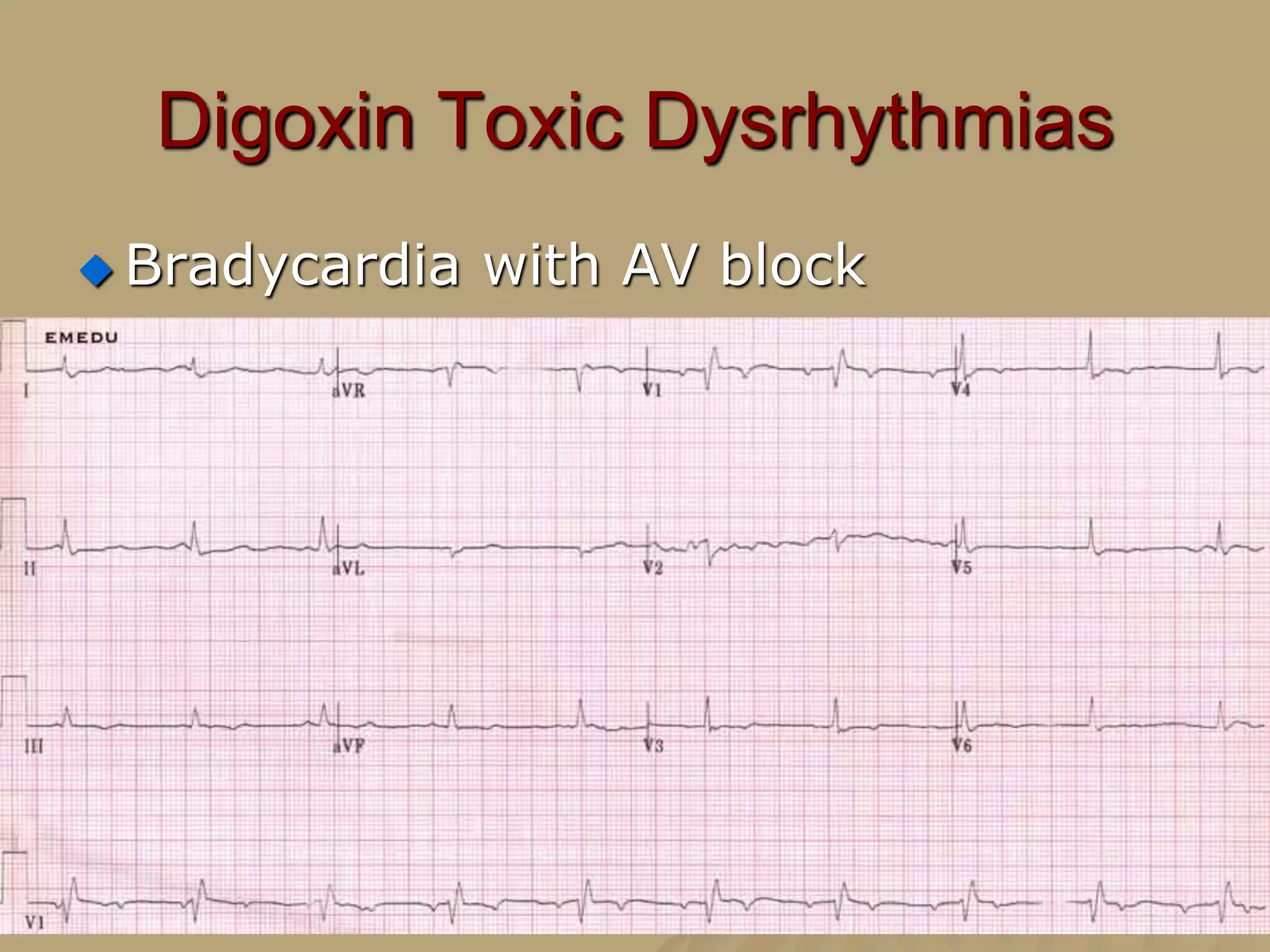 Digoxin- GLYCOSIDE | PPTX