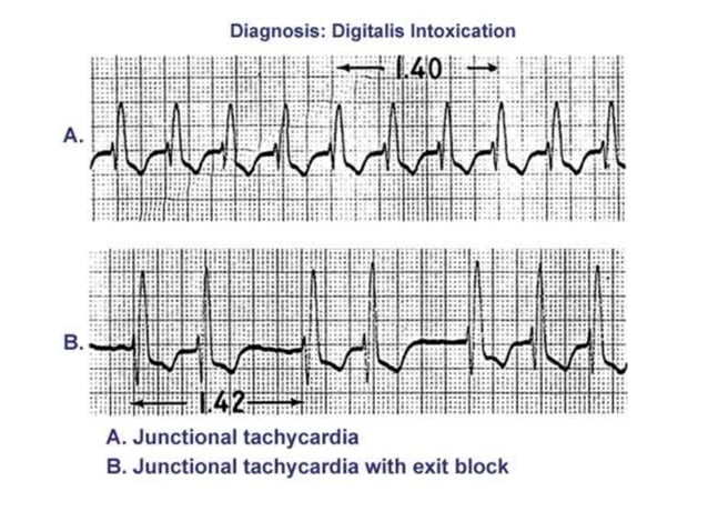 Digoxin toxicity | PPTX