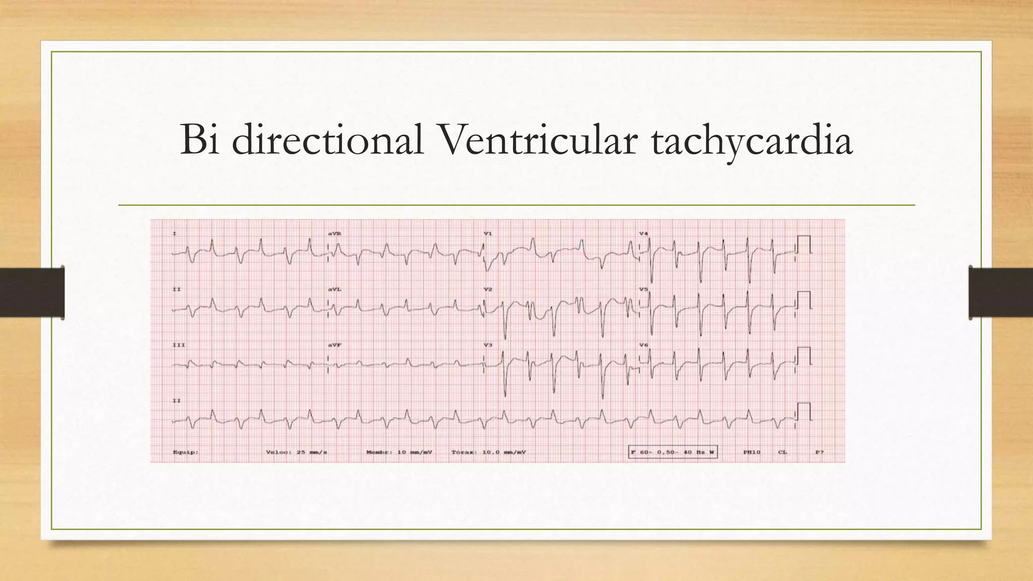 Digoxin toxicity | PPTX