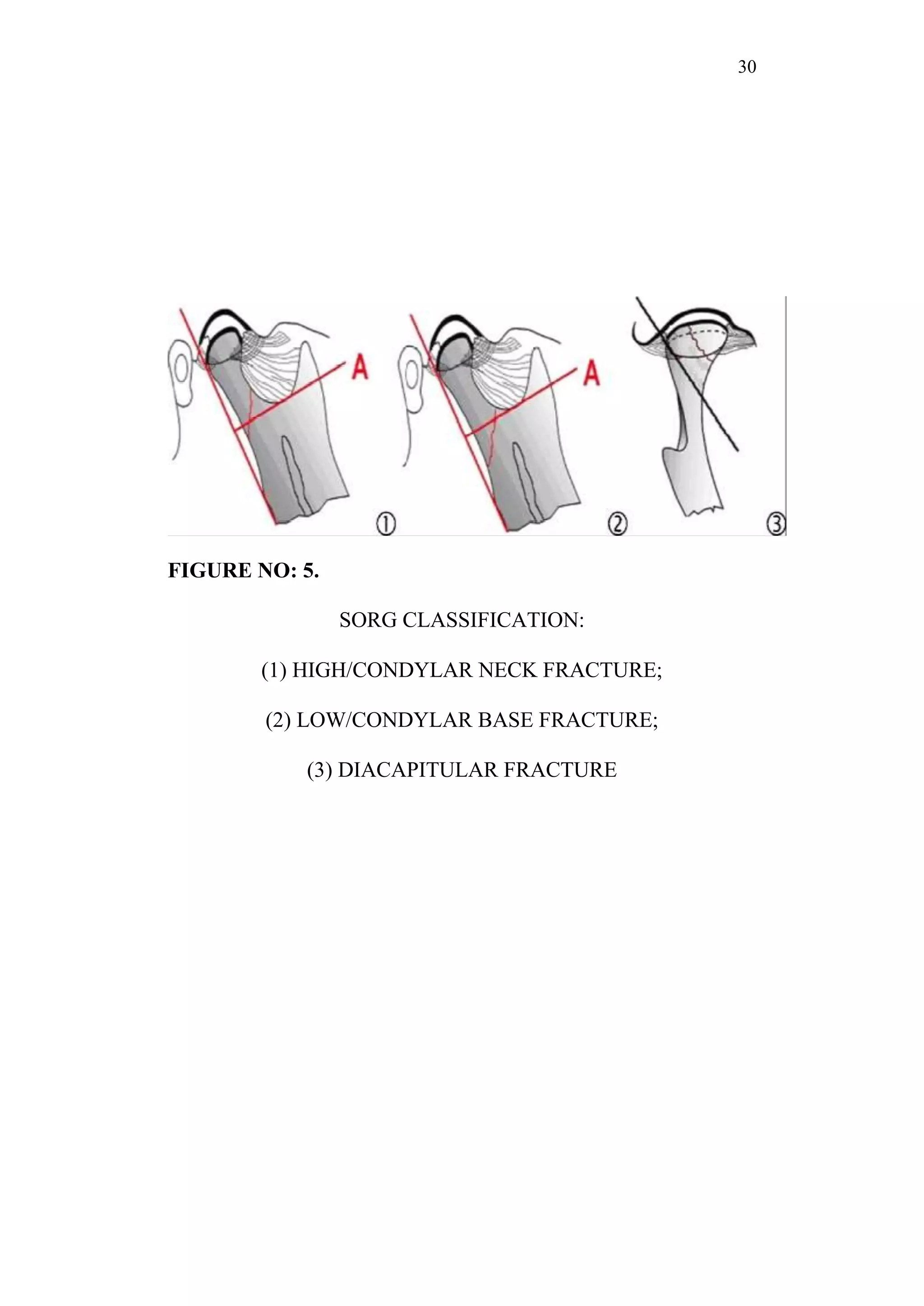 Patterns of condylar fractures | DOC